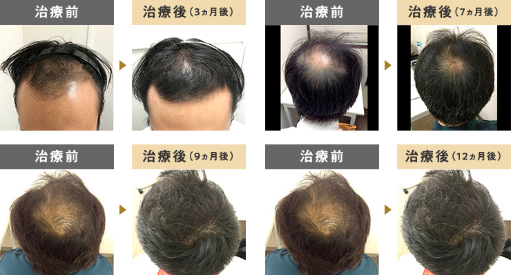 aga飲み薬, ハゲに効く薬 – HLZTF